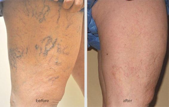 Vein Removal - Pacifica Center For Plastic Surgery